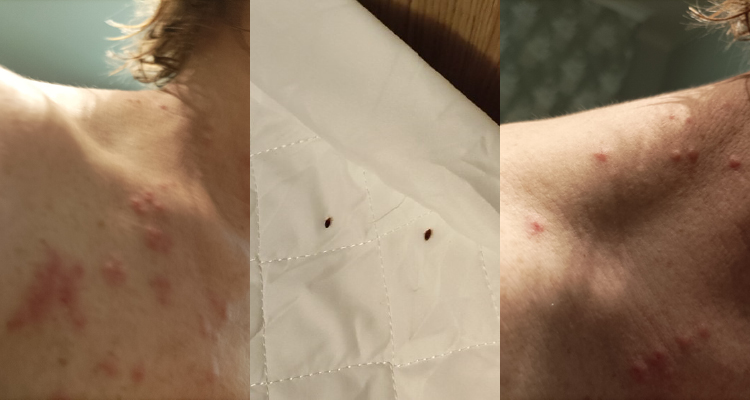 Bed Bug Horror Stories: Travellers Face Health Challenges Due To Bed ...